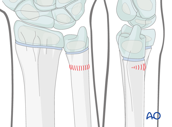 Short or long arm cast for Metaphyseal, torus/buckle fractures, ulna
