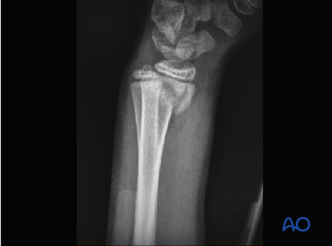 Multifragmentary epiphysiolysis with metaphyseal wedge, Salter-Harris ...