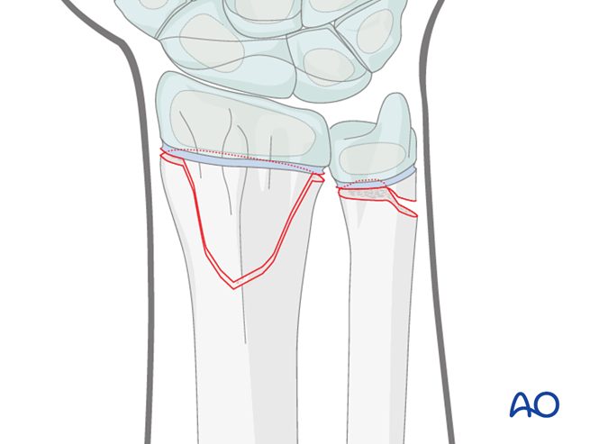 Closed Reduction K Wire Fixation For Simple Epiphysiolysis With