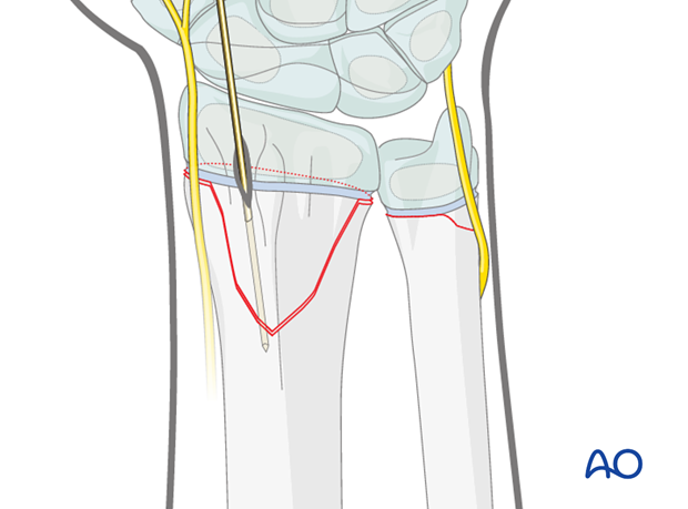 Closed Reduction K Wire Fixation For Simple Epiphysiolysis With