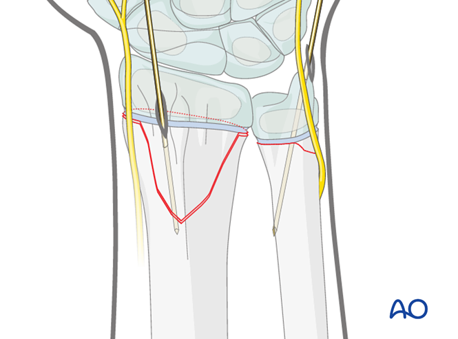 Closed reduction; K-wire fixation for Simple epiphysiolysis with ...
