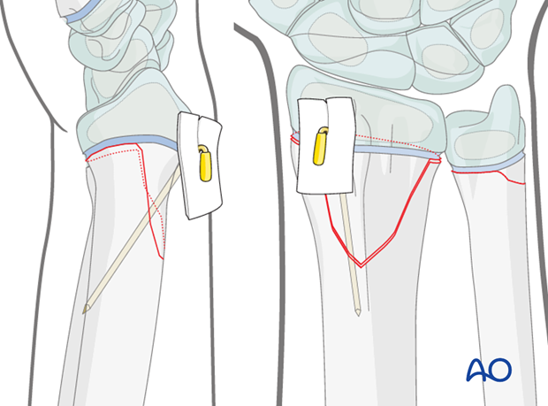 Closed Reduction K Wire Fixation For Simple Epiphysiolysis With
