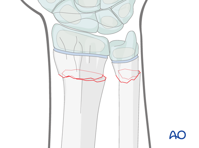 Long arm cast for Metaphyseal, simple complete, both bones