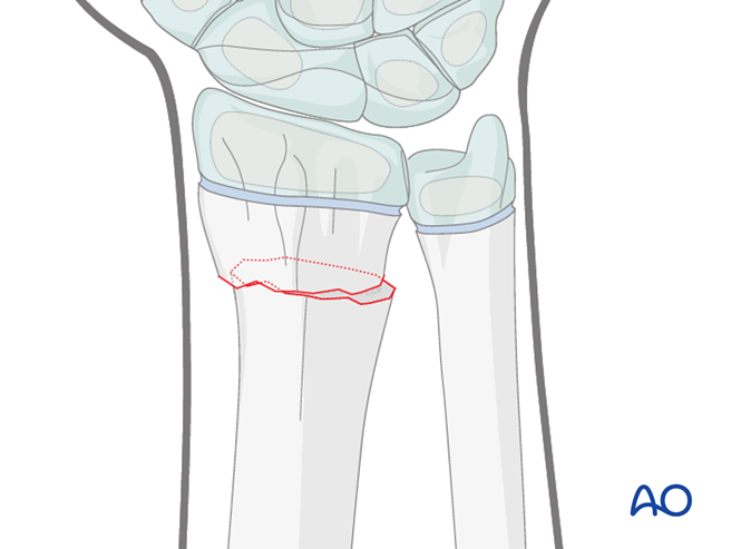 Short or long arm cast for Metaphyseal, simple complete, radius