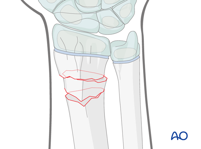 Closed reduction; long arm cast for Metaphyseal, multifragmentary ...