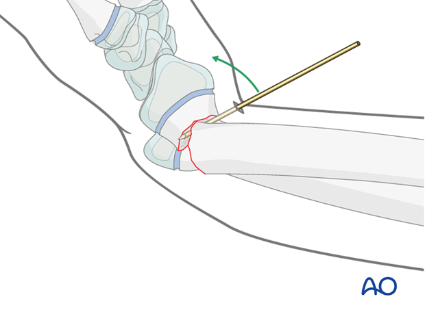 Closed Reduction K Wire Fixation For Metaphyseal Simple Complete Radius