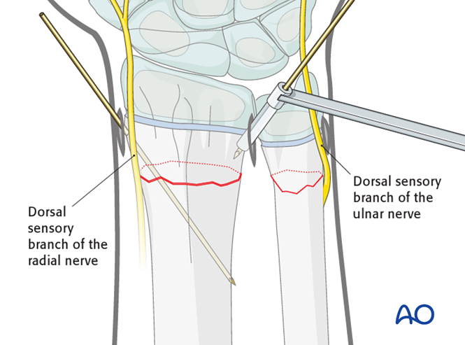 Closed reduction; K-wire fixation for Metaphyseal, simple complete ...