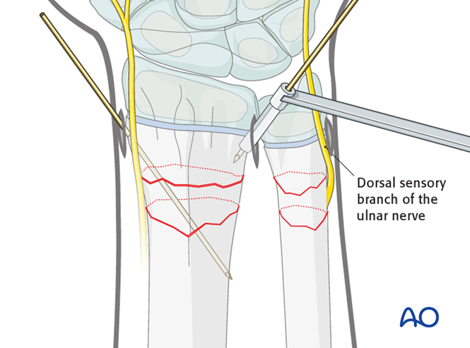 Closed reduction; K-wire fixation for Metaphyseal, multifragmentary ...