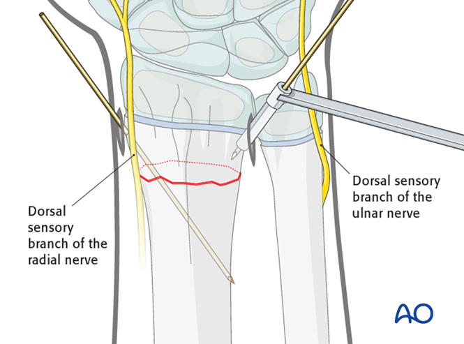 Closed reduction; K-wire fixation for Metaphyseal, simple complete, radius