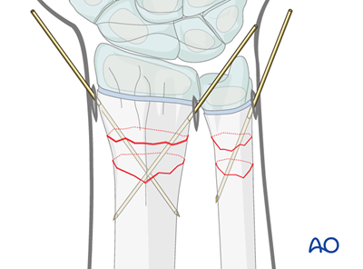 Open reduction; K-wire fixation for Metaphyseal, multifragmentary ...