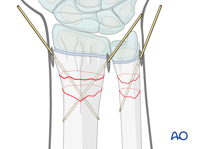 Open reduction; K-wire fixation for Metaphyseal, multifragmentary ...