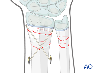 Closed reduction; K-wire fixation for Metaphyseal, multifragmentary ...