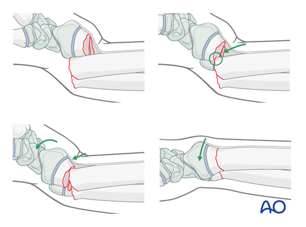 Closed Reduction K Wire Fixation For Metaphyseal Simple Complete