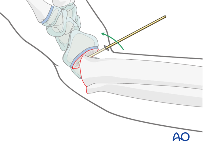Closed reduction; short or long arm cast for Simple epiphysiolysis ...
