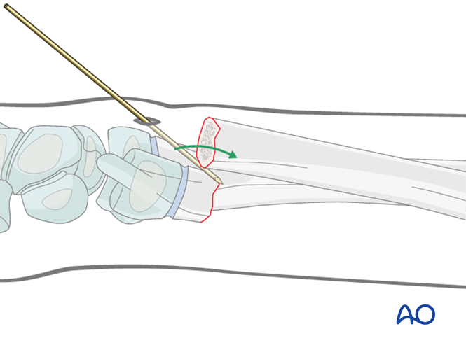 Closed reduction; long arm cast for Metaphyseal, simple complete, ulna
