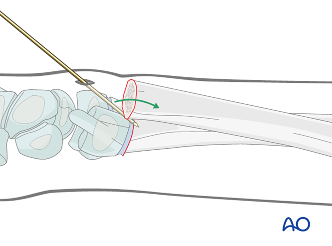 Closed reduction; long arm cast for Simple epiphysiolysis, Salter ...