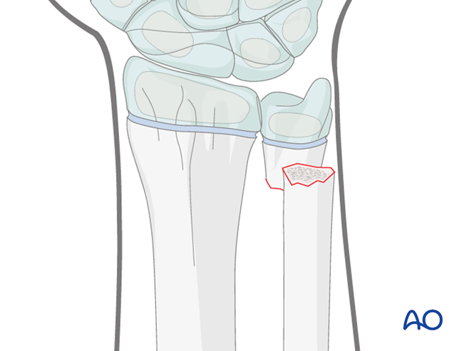 Open reduction; K-wire fixation for Metaphyseal, simple complete, ulna