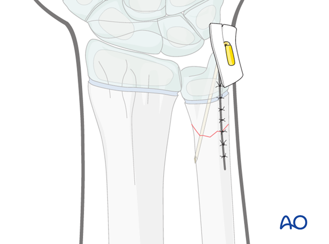 Open reduction; K-wire fixation for Metaphyseal, simple complete, ulna