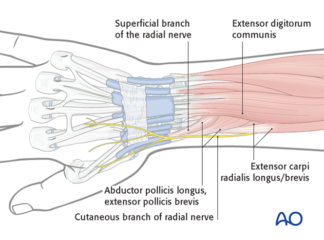 External fixation for Metaphyseal, multifragmentary complete, radius