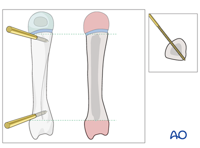 External fixation for Metaphyseal, simple complete, both bones