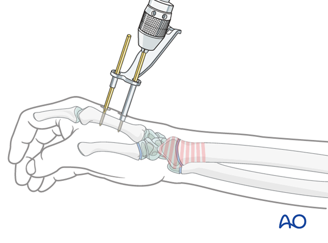 External fixation for Metaphyseal, multifragmentary complete, radius