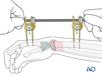External fixation for Metaphyseal, simple complete, both bones