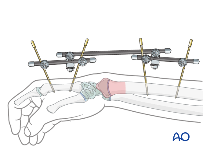 External fixation for Metaphyseal, simple complete, radius