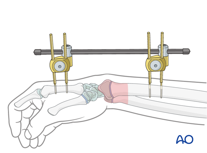 External fixation for Metaphyseal, multifragmentary complete, both bones