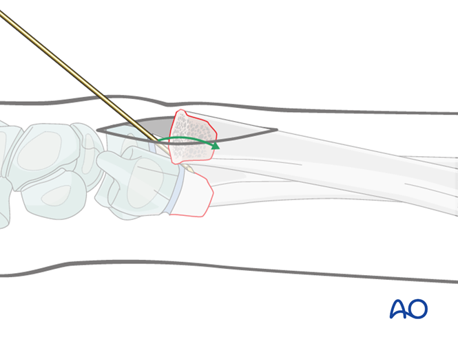 Open Reduction K Wire Fixation For Simple Epiphysiolysis With