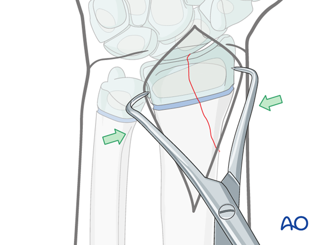 Open Reduction K Wire Fixation For 23r E 4 1 Simple Epi Metaphyseal