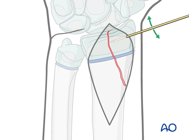 Open Reduction K Wire Fixation For 23r E 4 1 Simple Epi Metaphyseal