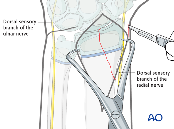 Open reduction; K-wire fixation for Simple epi-/metaphyseal fracture ...