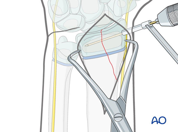 Open Reduction K Wire Fixation For 23r E 4 1 Simple Epi Metaphyseal