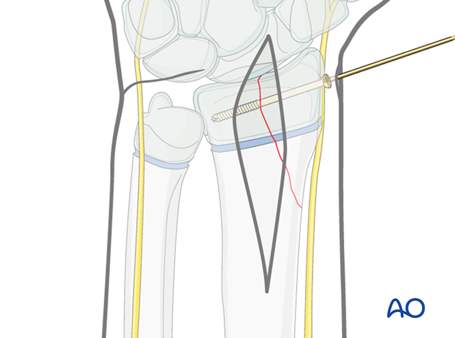 Open Reduction K Wire Fixation For 23r E 4 1 Simple Epi Metaphyseal
