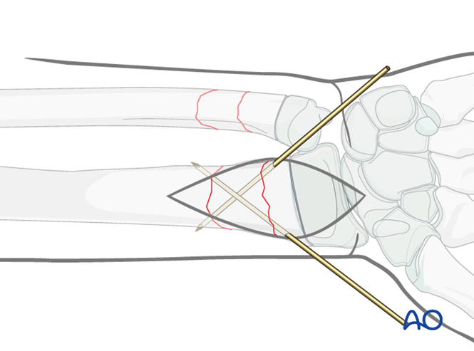 Open reduction; plate fixation for Metaphyseal, multifragmentary ...