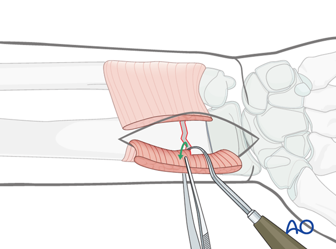 Open reduction; plate fixation for Metaphyseal, simple complete, radius