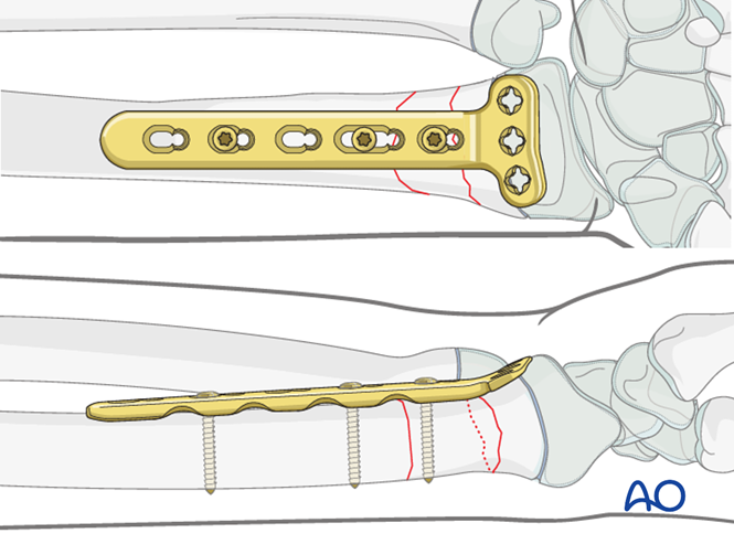 Open reduction; plate fixation for Metaphyseal, multifragmentary ...