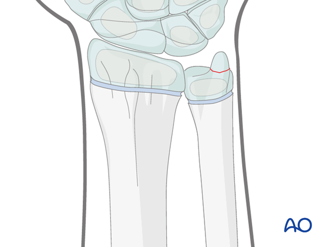 Splint for Avulsion of the styloid, ulna