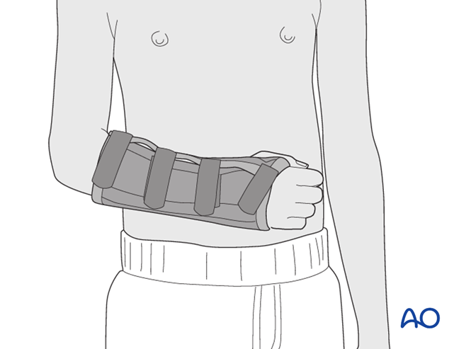 Splint for Metaphyseal, torus/buckle fractures, radius