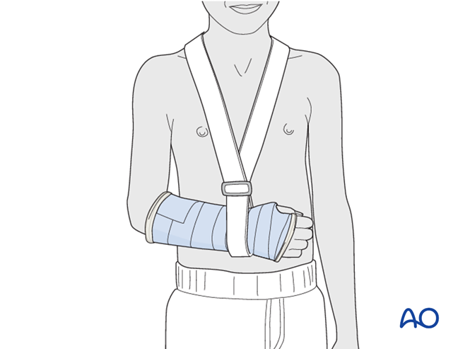 Splint for Avulsion of the styloid, ulna