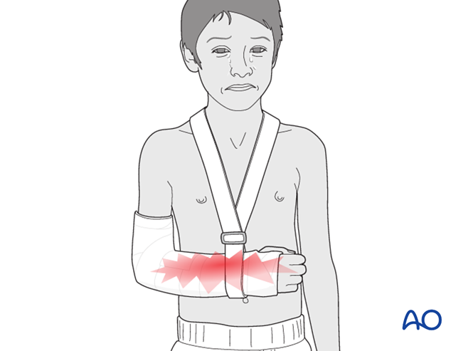 Short or long arm cast for Simple epiphysiolysis, Salter-Harris I, ulna