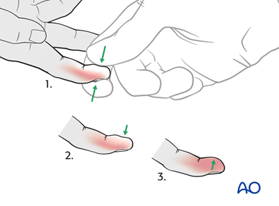 Long arm cast for Multifragmentary epiphysiolysis with metaphyseal ...