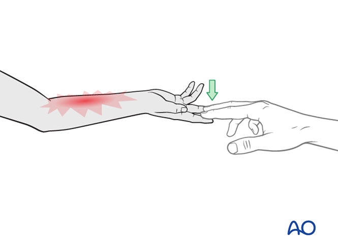 Short or long arm cast for Simple epiphysiolysis, Salter-Harris I, both ...