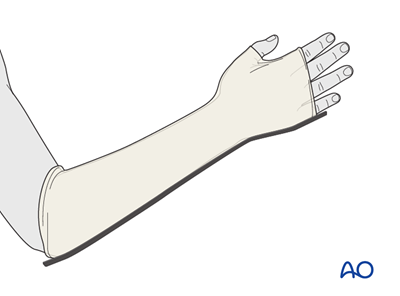 Short arm cast
