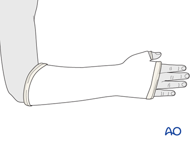 Short arm cast