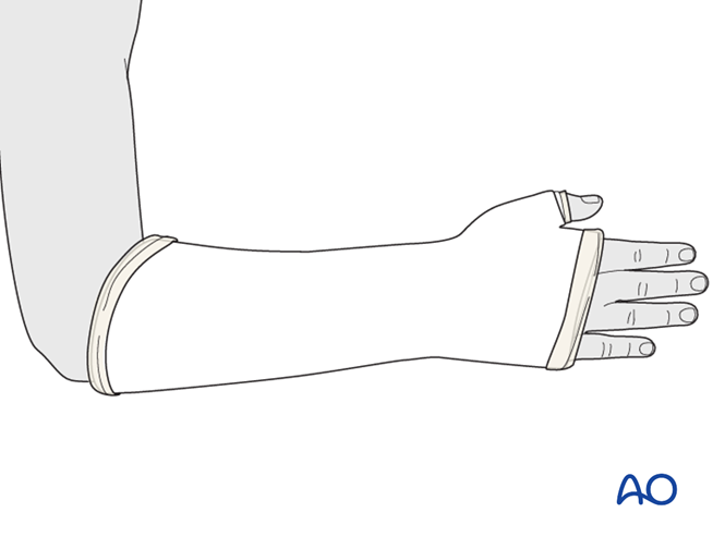 Short arm cast