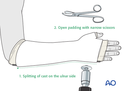 Short or long arm cast for Metaphyseal, simple complete, radius