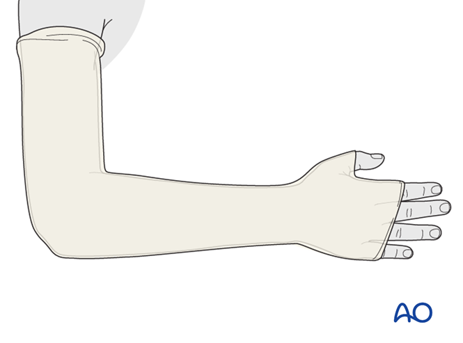 Long arm cast