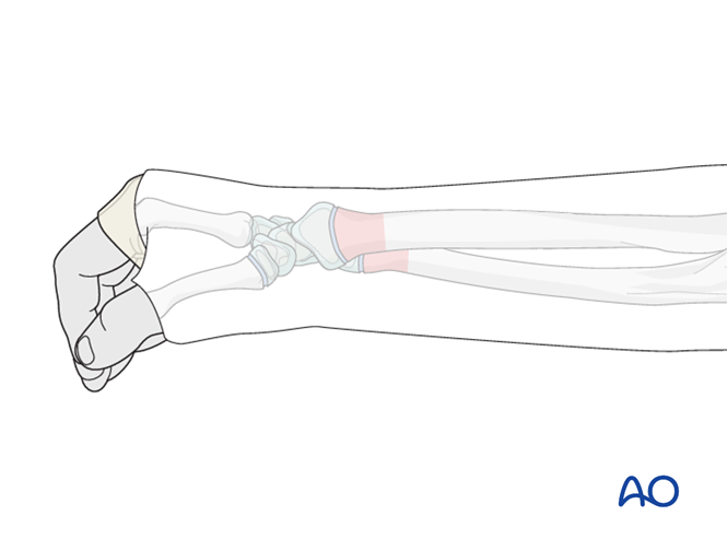 Long arm cast