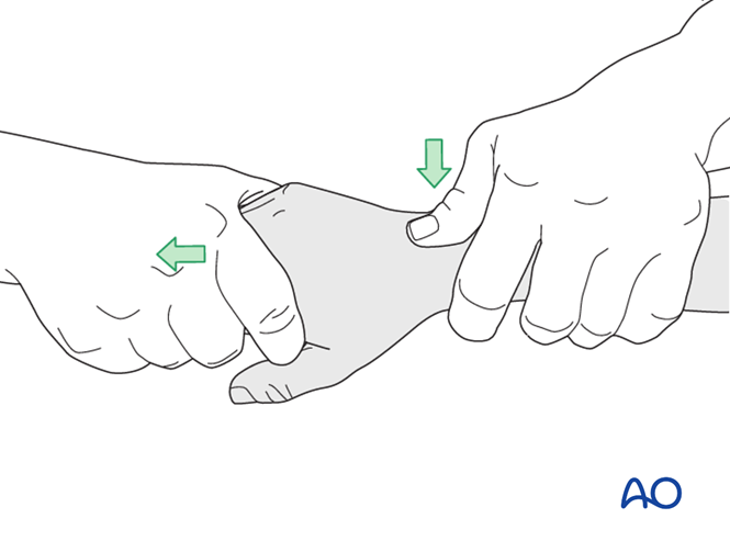 Closed reduction; short or long arm cast for Simple epiphysiolysis ...
